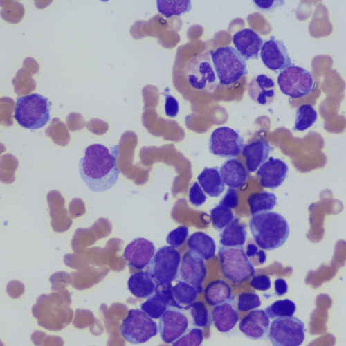 Mielóma multiplex - Trombózis- és Hematológiai Központ