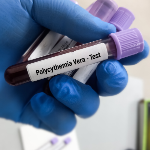 Policitémia vera - Trombózis- és Hematológiai Központ